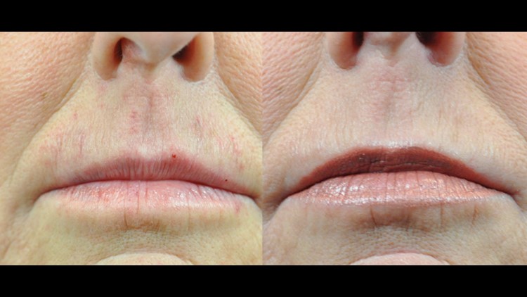 A Fix For: 'What did you do to your lips?' | wthr.com