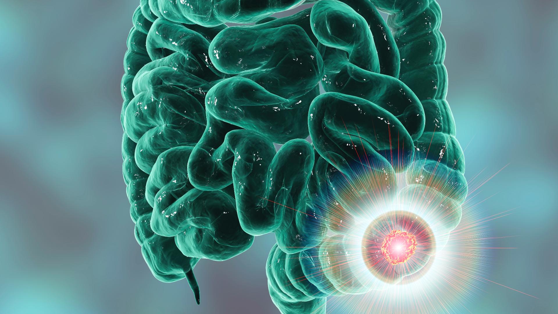 Colorectal cancer signs and symptoms | wthr.com