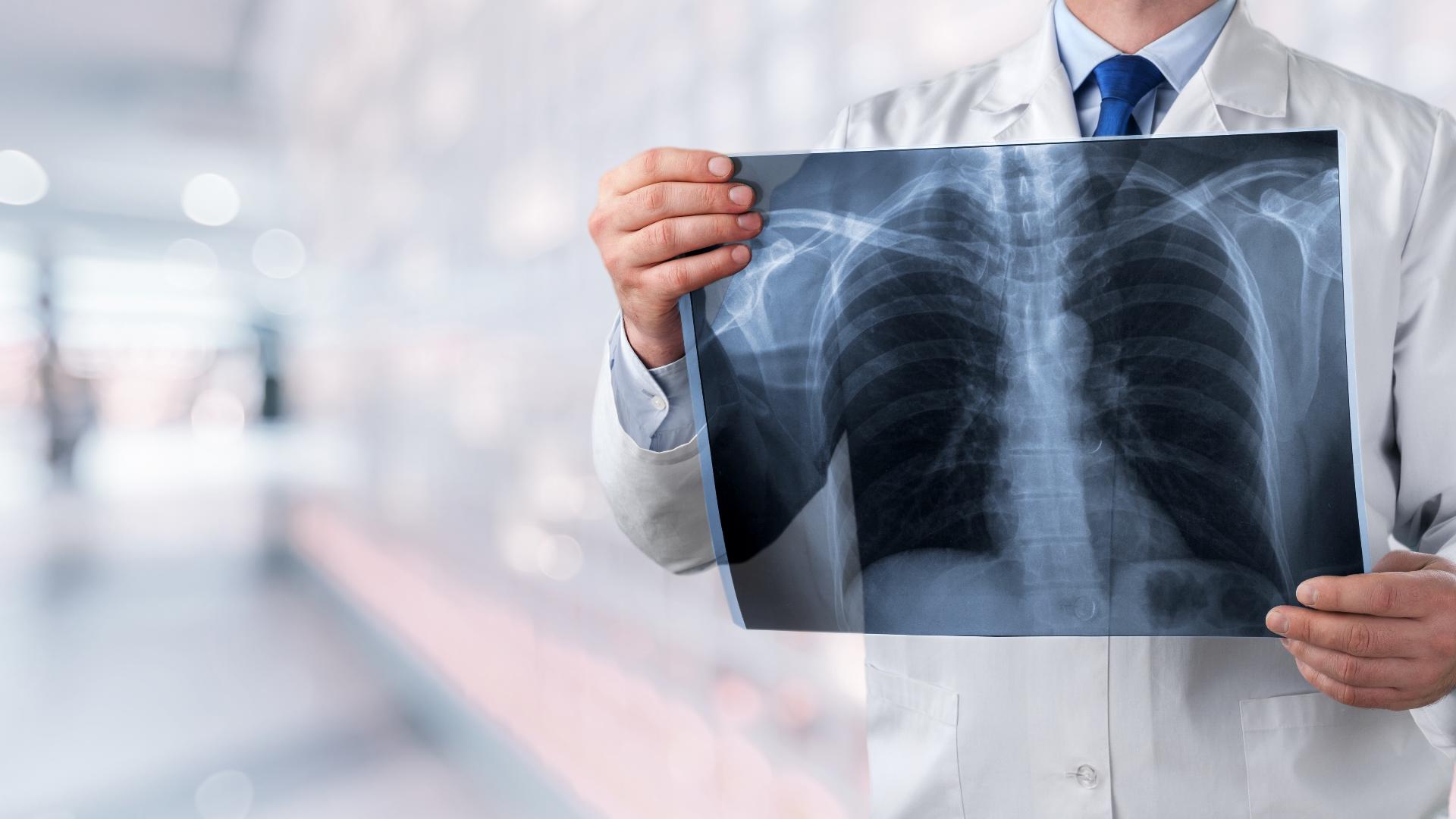 Lung cancer and the importance of early detection | Real Men Wear Gowns ...