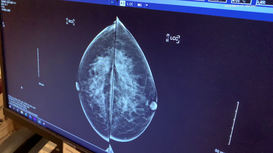 Check Up 13: The importance of regular mammograms | wthr.com