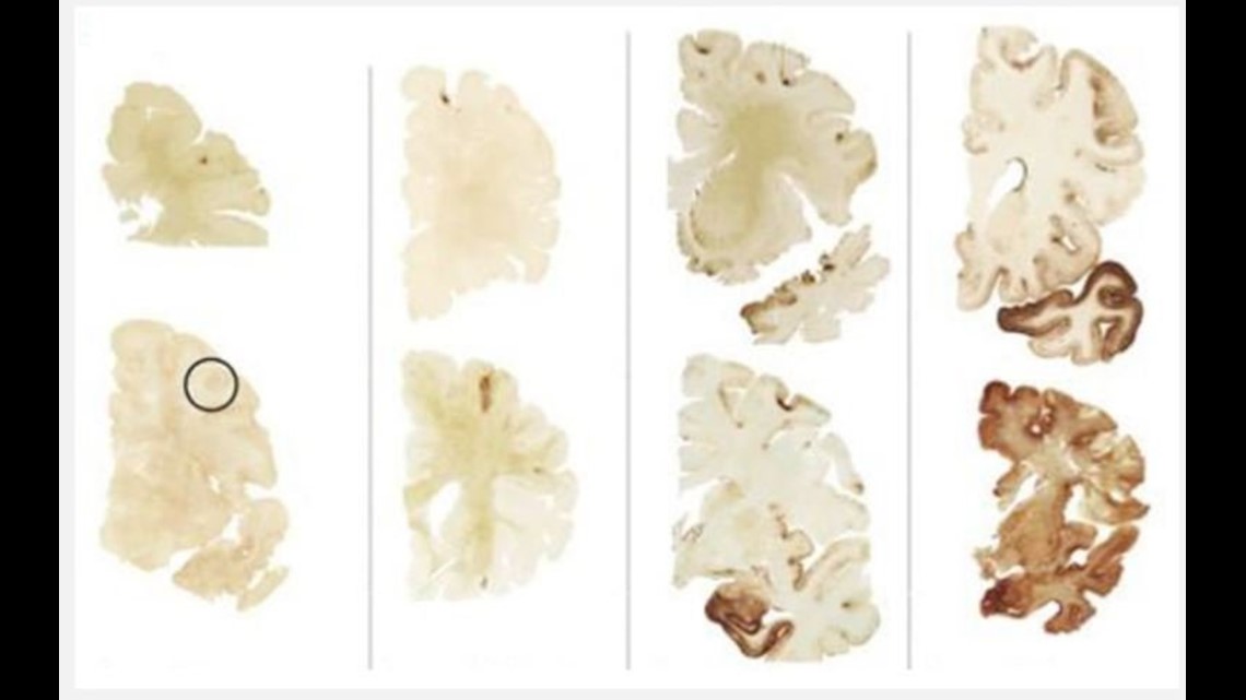 Ex-NFL player confirmed as 1st case of CTE in living patient | fox61.com