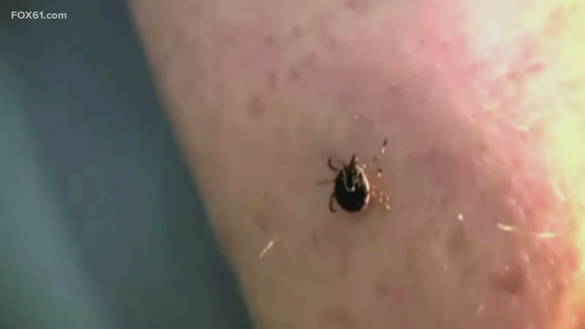 Measles cases at record high, tick bites, new study on American kids ...