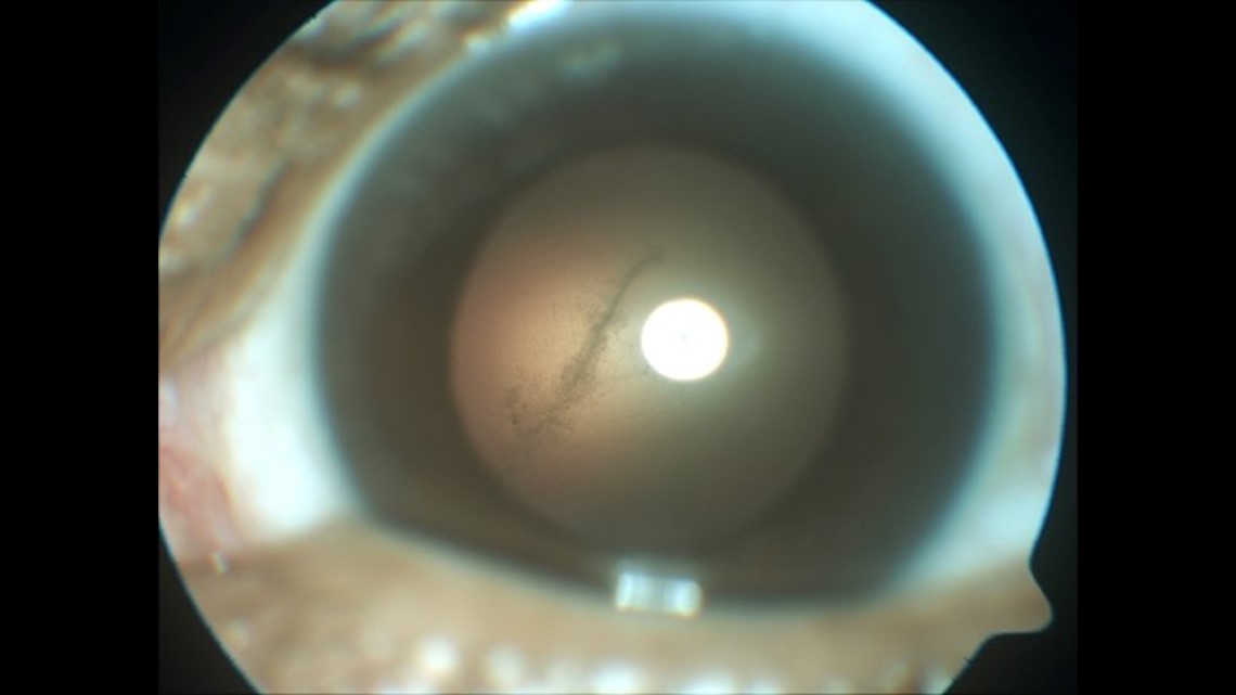 Brain-eating worm grows in Florida man’s eye | fox61.com