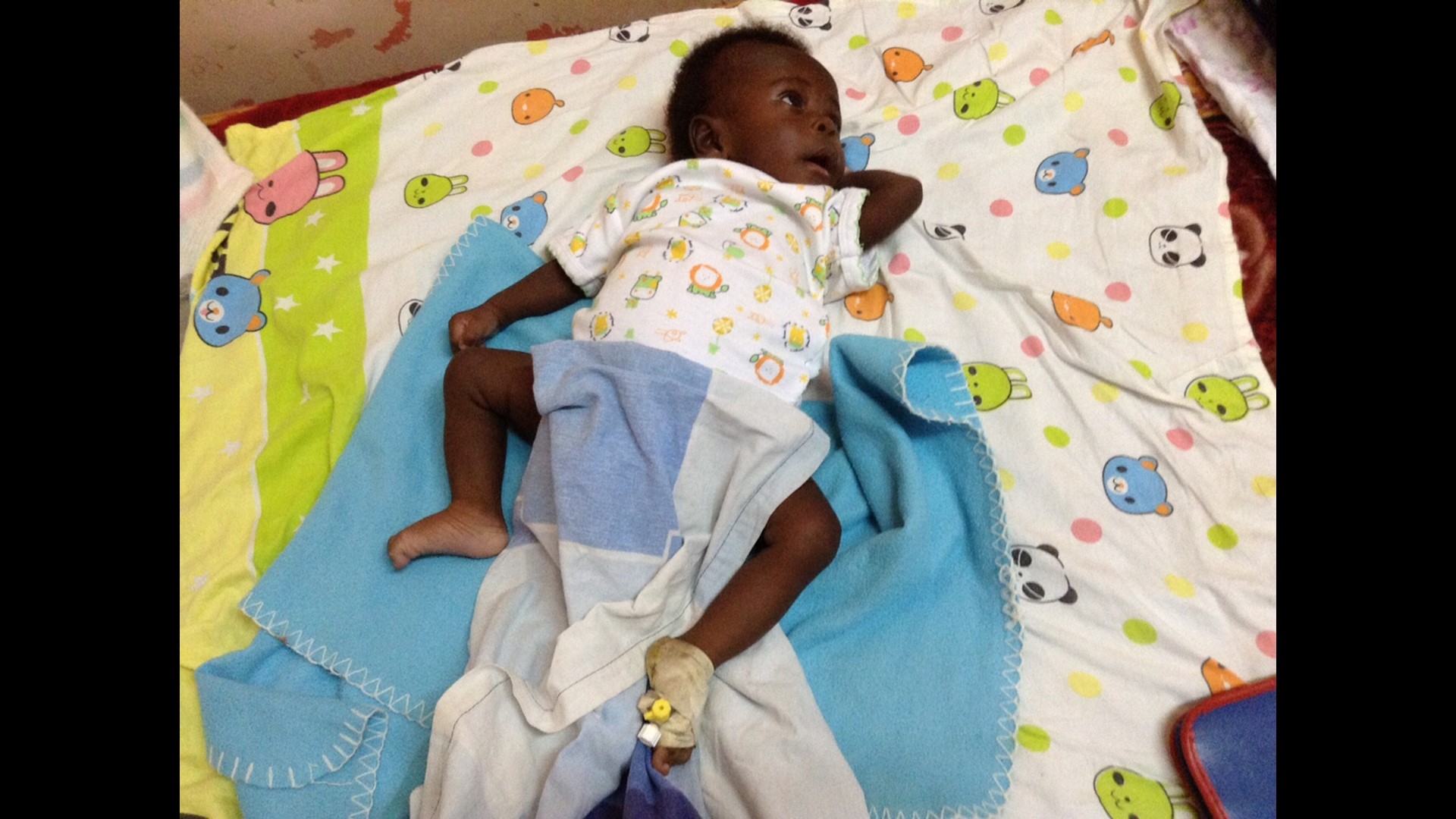 Baby Boy With Eight Limbs Progressing Well After Successful Operation ...