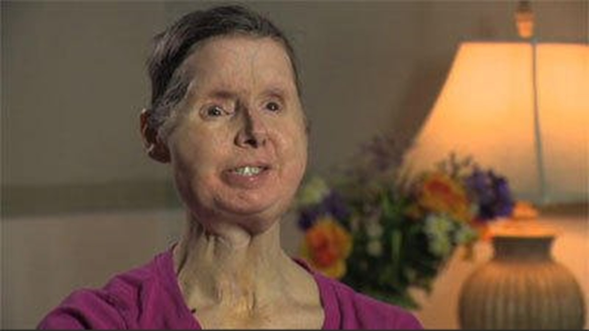 Chimp Attack Victim Makes Case In Attempt To Sue State | fox61.com