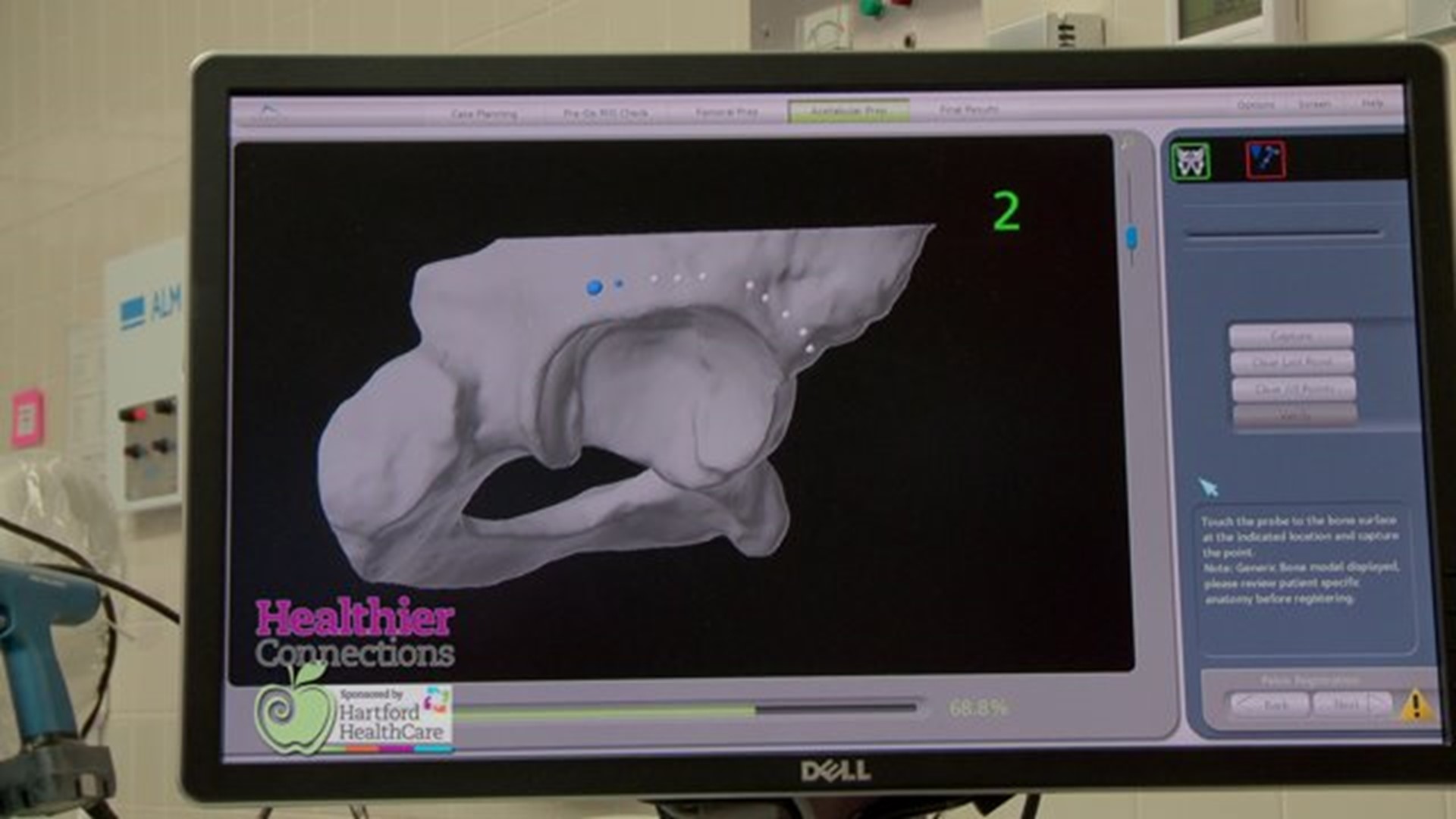 Healthier Connections: Robotic surgery at Backus Hospital | fox61.com