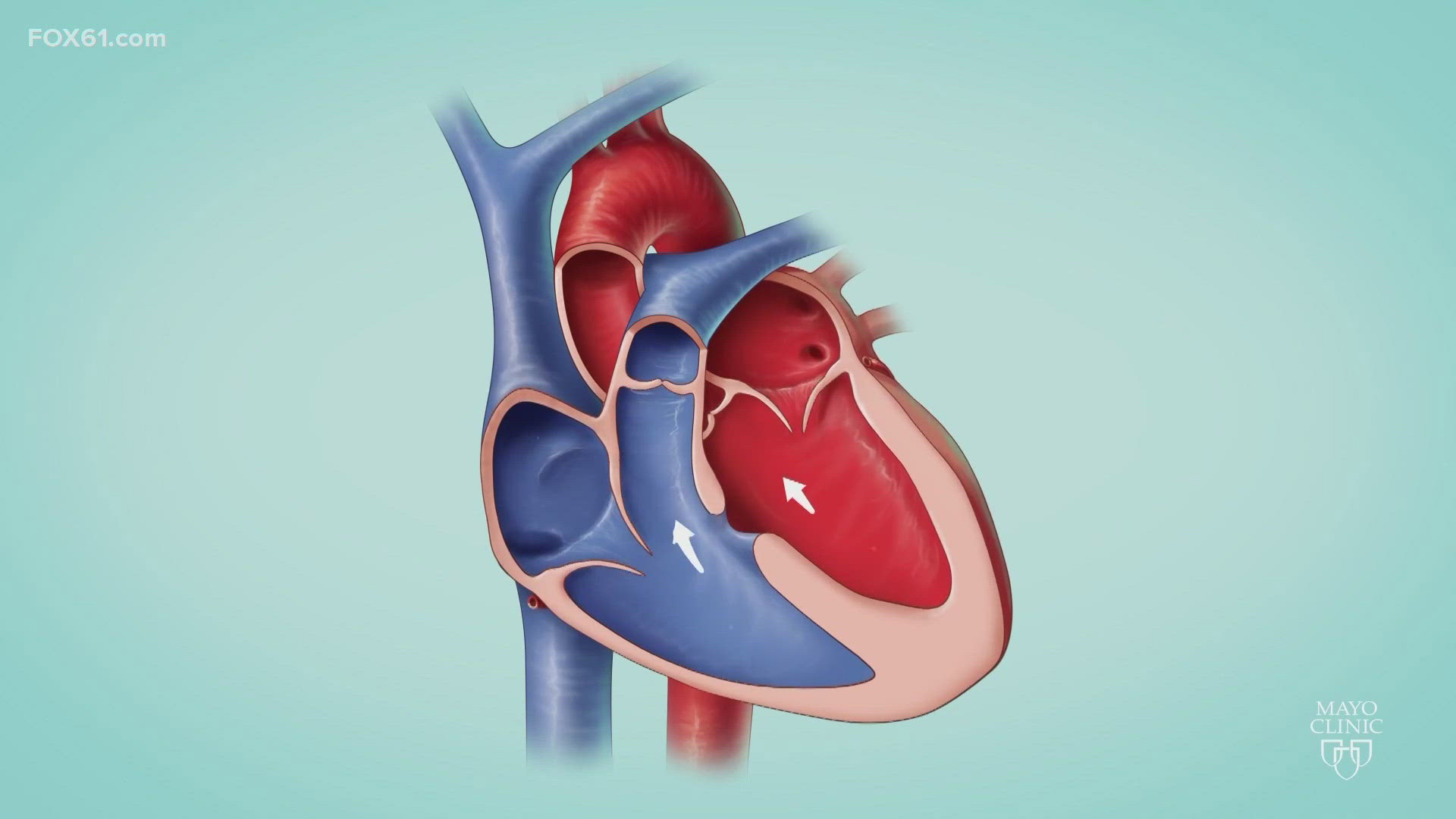 Paid leave benefits are available in CT for people with chronic heart ...