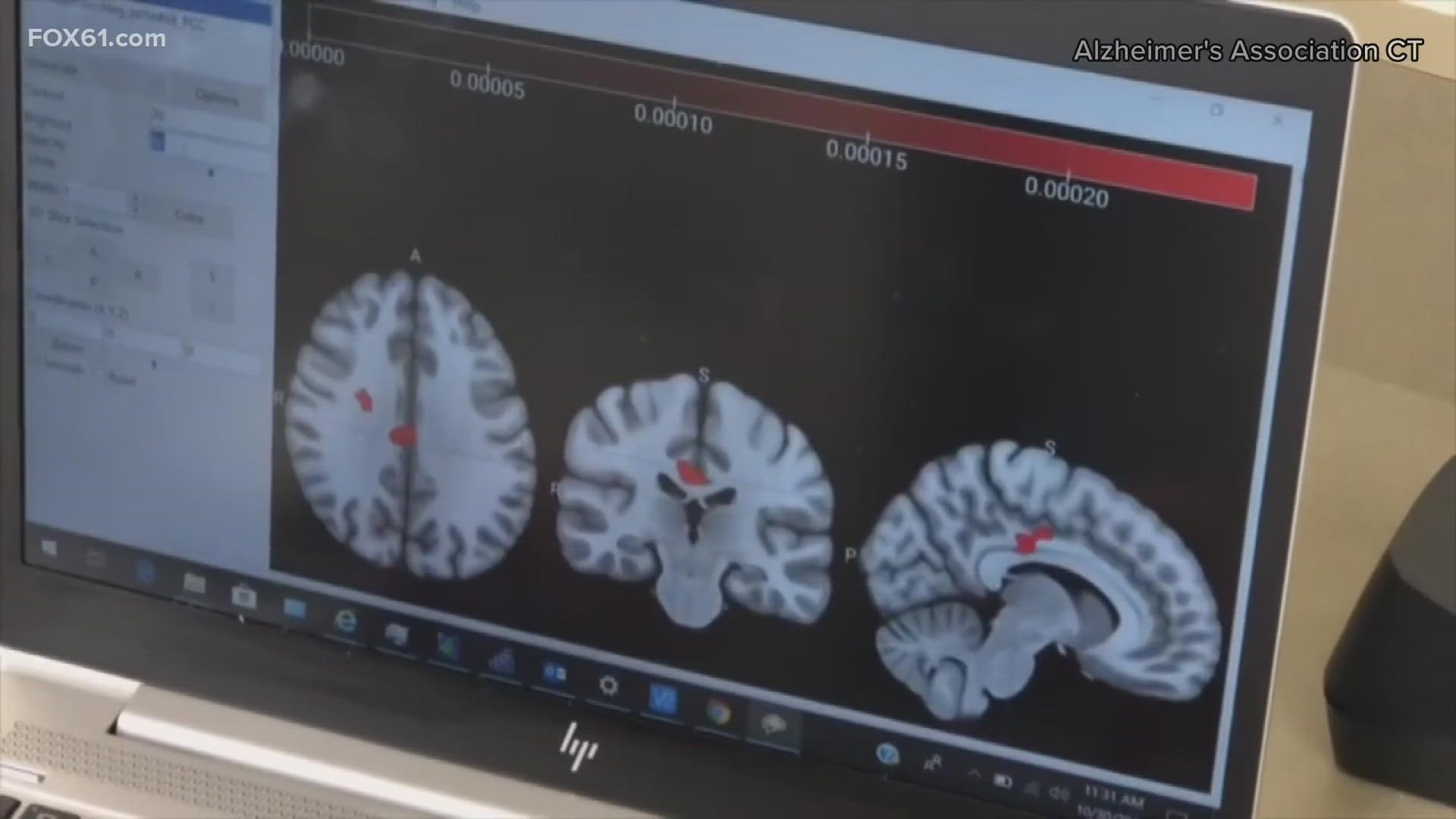 Alzheimer's researchers seek possible gender differences in disease impact | fox61.com