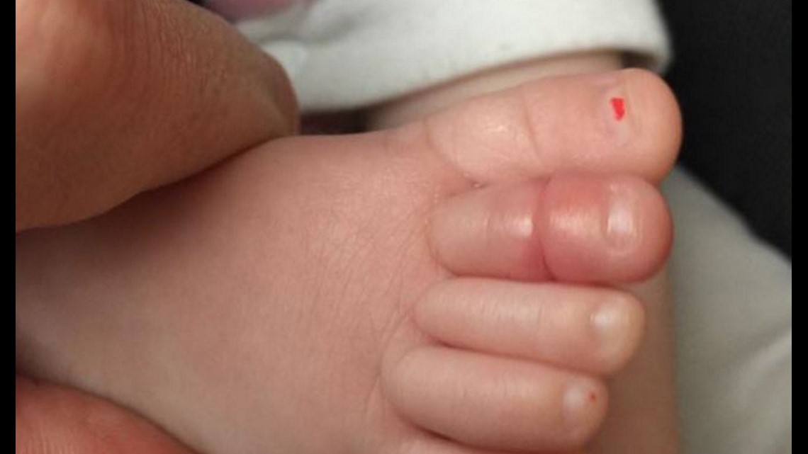 Hair tourniquet? Dad shares photo of baby’s swollen toe to warn parents ...