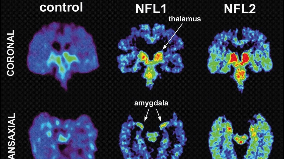 NFL exec admits to CTE-football head trauma link | fox61.com