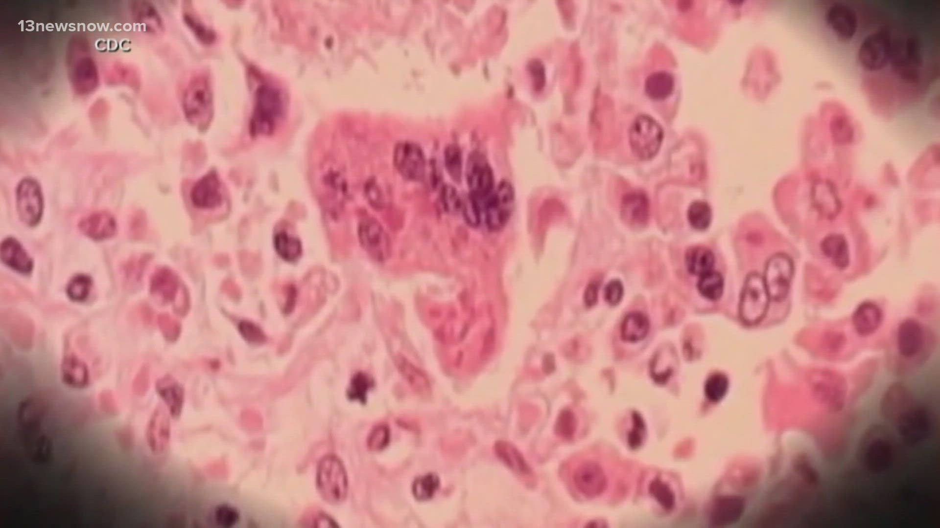 Iowa HHS reports measles in vaccinated adult for state's 8th case of ...