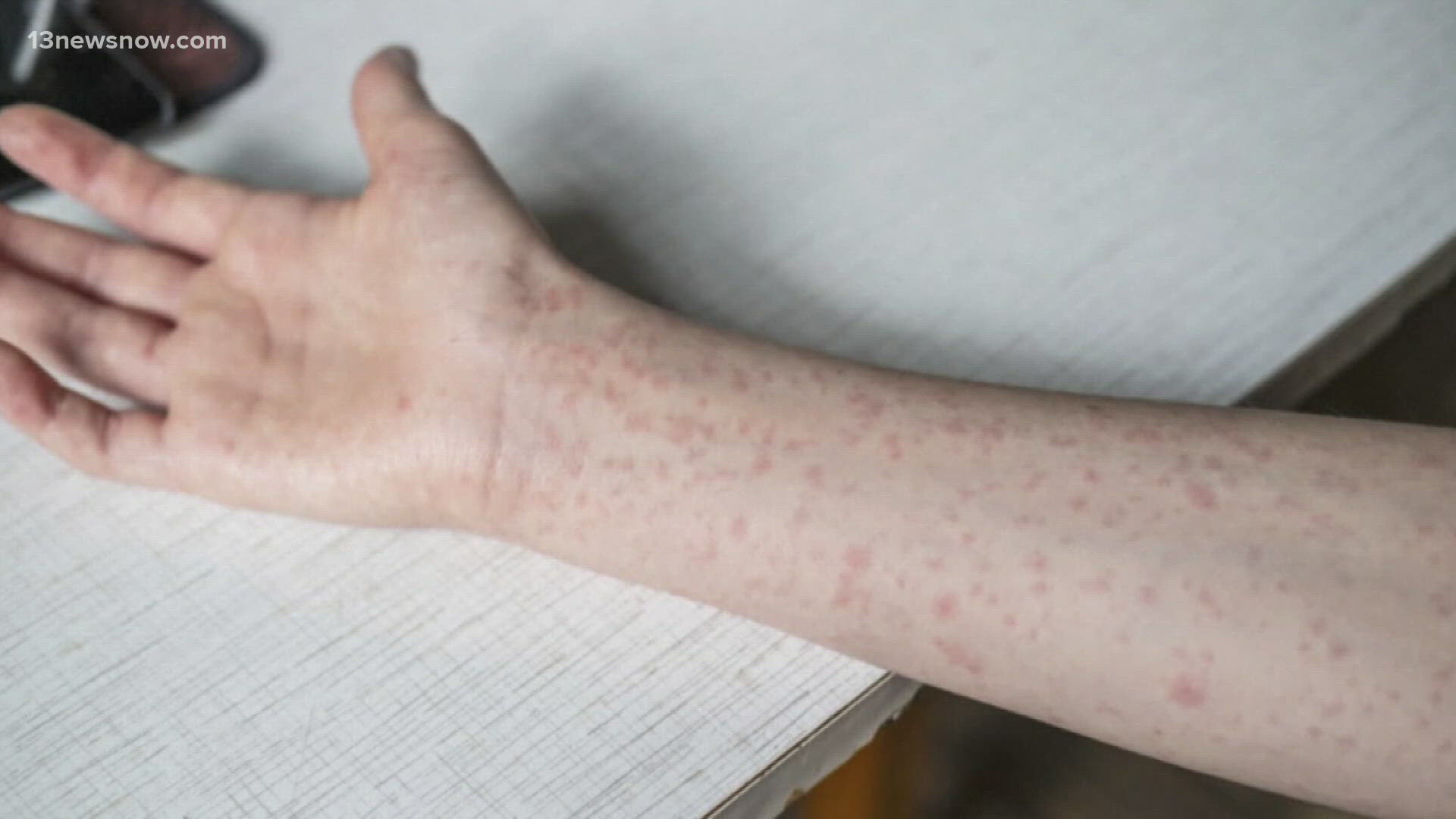 New map shows how to spot the measles risk level in your ZIP code ...