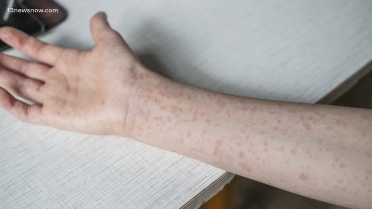 New map shows how to spot the measles risk level in your ZIP code ...