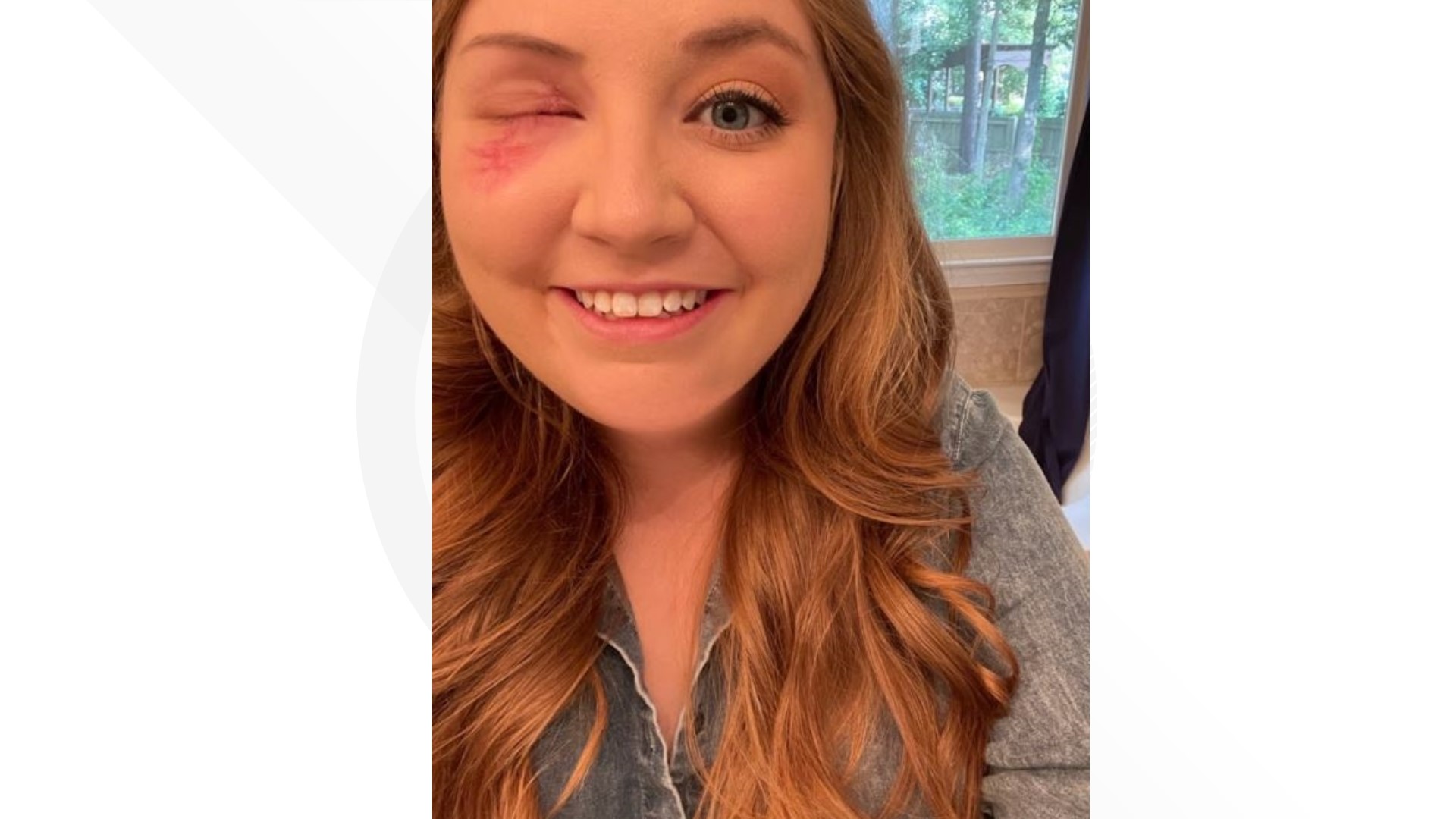 Georgia woman's sunglasses shatter causing life-changing injury | fox43.com