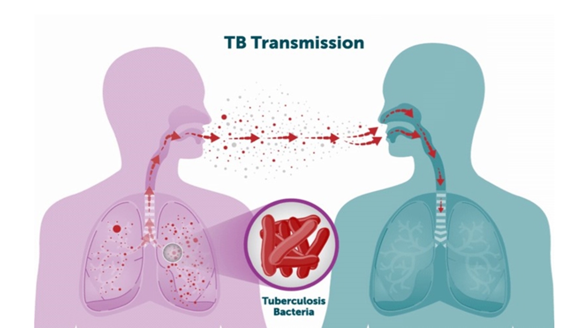 Tuberculosis case sparks fear of outbreak, ADPH official says spread is ...